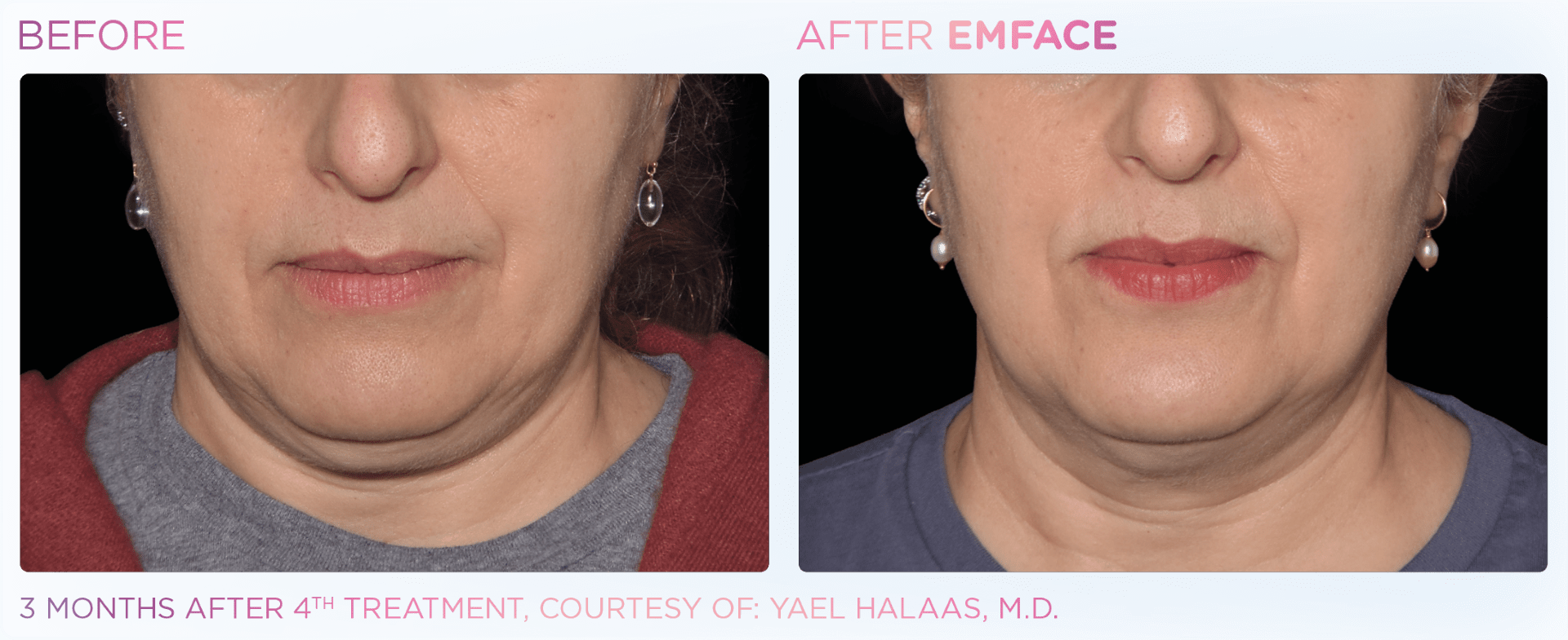 Emface Submentum Perth | Non-Surgical Double Chin Removal